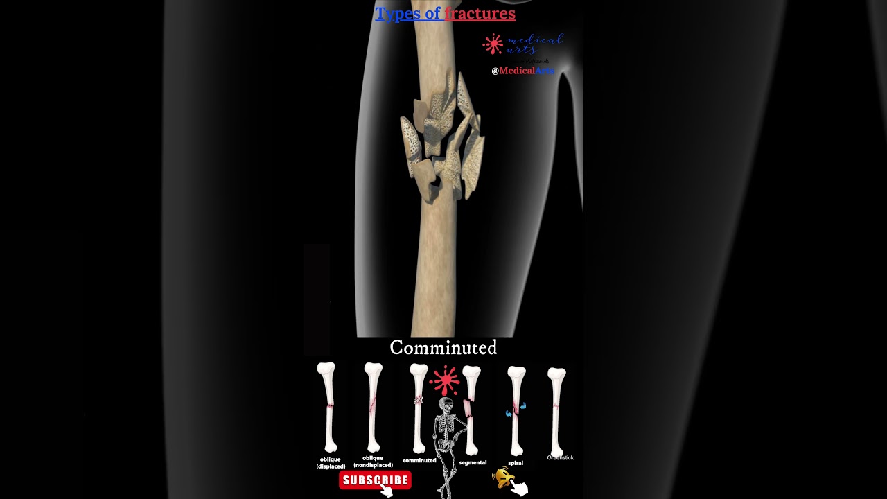 Types of bone fractures 🦴 bone fractures
