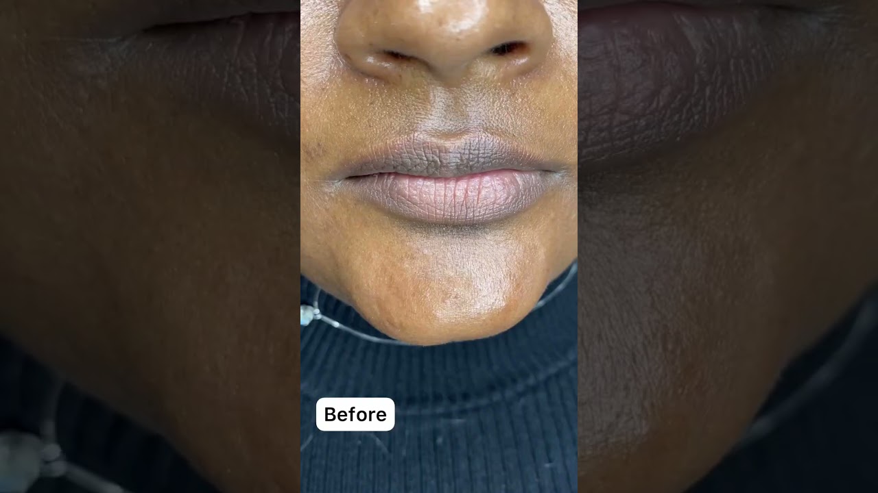 5 sessions healed dark lip neutralization result #permanentmakeup #pmu #darklipcorrection