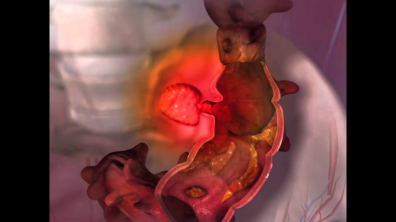 Diverticulitis: Learn@Visible Body
