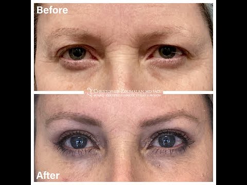 Before and After Endoscopic Brow Lift and Blepharoplasty Surgery.