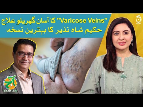 Natural home remedies to treat "Varicose Veins" - Hakeem Shah Nazir Remedies - Aaj Pakistan
