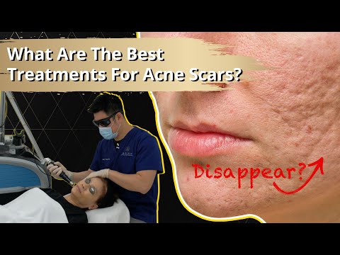 What Are The Best Treatments For Acne Scars?