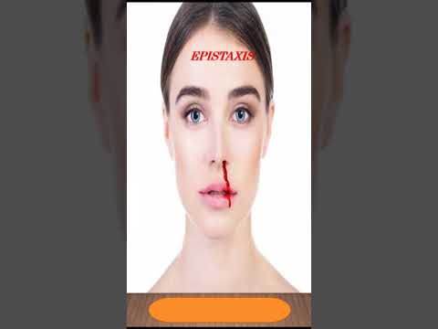Epistaxis Treatment | Best Medicine Use In Epistaxis Disease