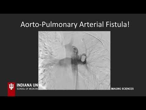 Traumatic aortic injury