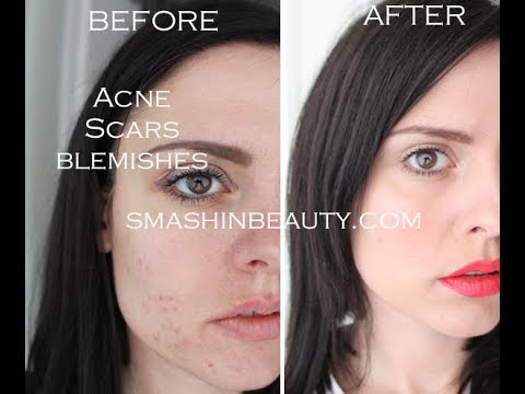 Acne Gone in 5 mins- Powerful Makeup Tranformation – TUBE CENTURY