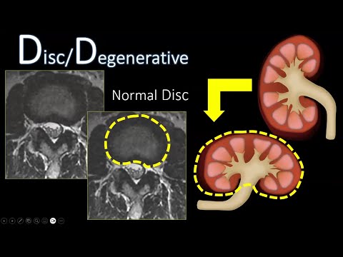 The ABC's of Degenerative Spine Imaging