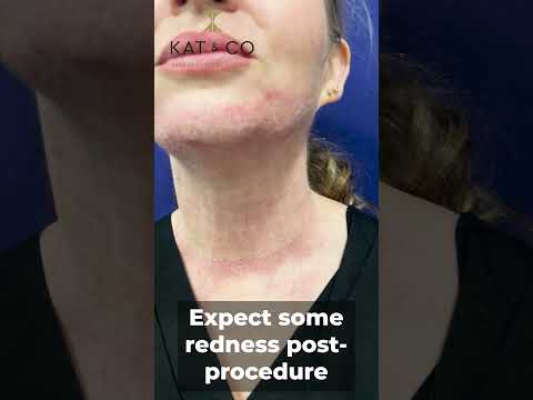 CO2 Laser Non-Surgical Necklift 😍 | Kat & Co