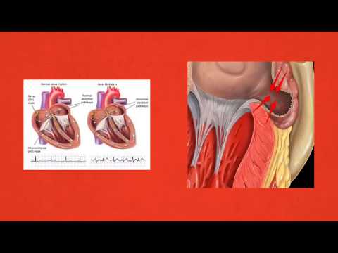 Left atrial Appendage Anatomy and Clinicals