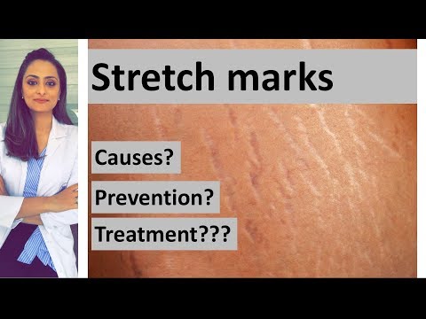 Stretch marks: causes, prevention, treatment | Dermatologist | Dr. Aanchal Panth