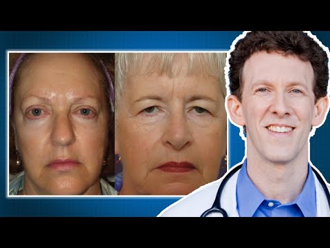 Doctor Explains What is a "Resting Bitchy Face"