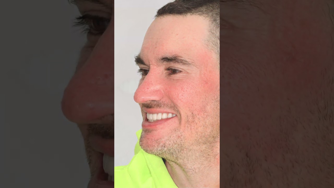 Robert’s All-On-4 smile makeover! #smilemakeover #allon4