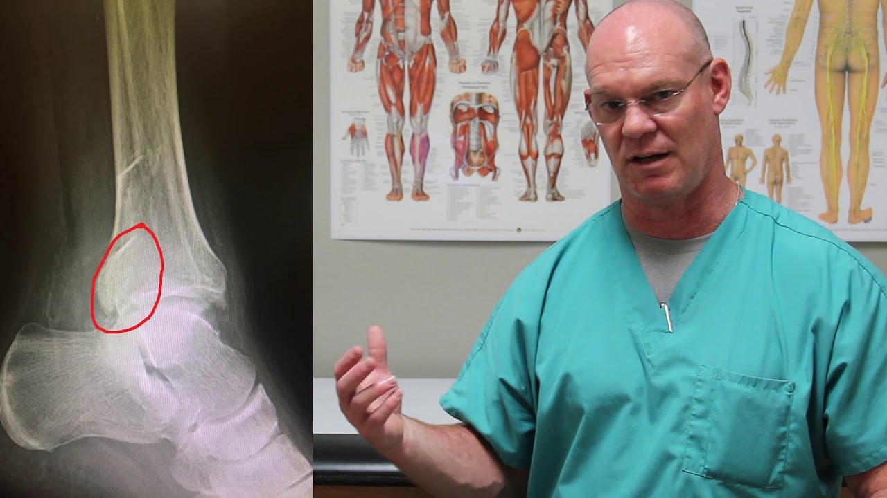 Three Part Broken Ankle | Fracture Friday Episode 19