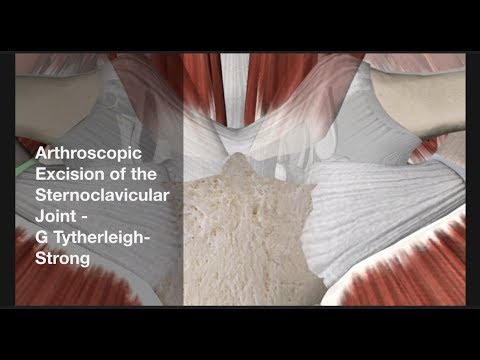 Arthroscopic Excision of the Sternoclavicular Joint