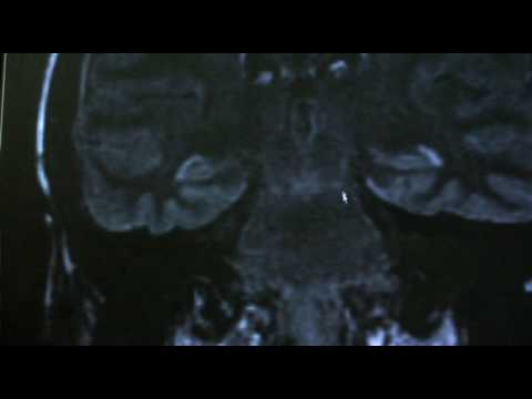 What's the difference between a stroke and a seizure?