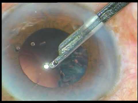 Playing gently with the pupil in a Phaco of a NS3 Cataract - PM, 5th March, 2018