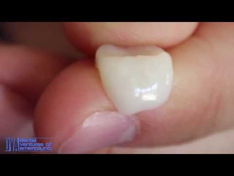 HYBrite Polish | HYBrite Polishes A 3M Lava Ultimate Crown In Less Than 30 Seconds!