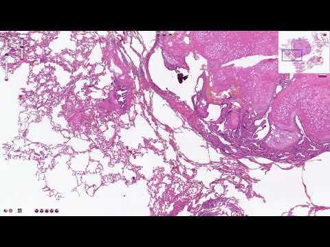 Pulmonary Hamartoma - Histopathology