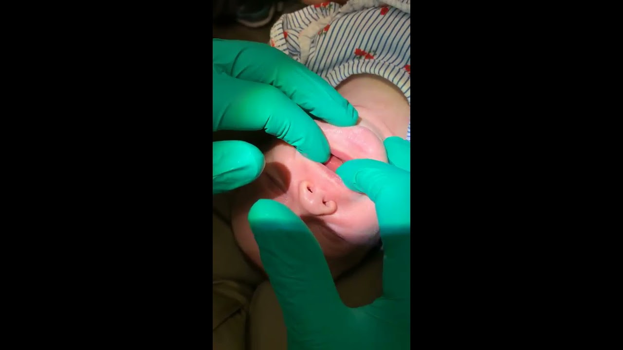 Tongue and Lip Tie Stretches After Procedure