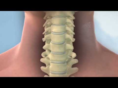 What to know about cervical disc arthroplasty