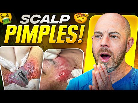 Doctor Reacts to Skin Tag Removals, Pimple Pops, and Extractions