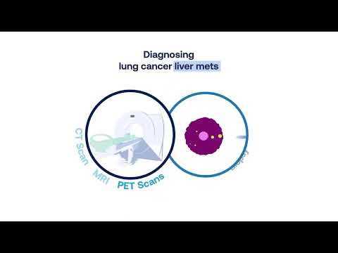 Lung Cancer Liver Metastasis: Symptoms, Diagnosis, and Treatment (2 min)