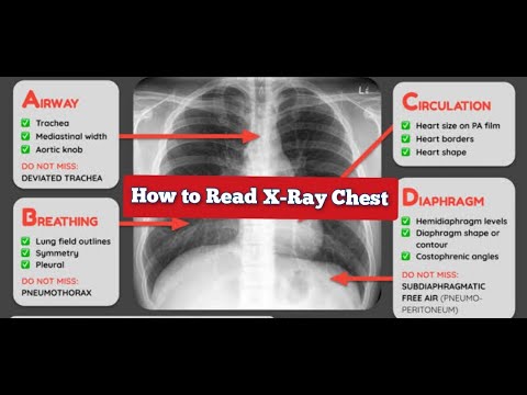 Viva of Chest Radiology | Basic Points to read X-Ray Chest #medical #radiology #ultrasound