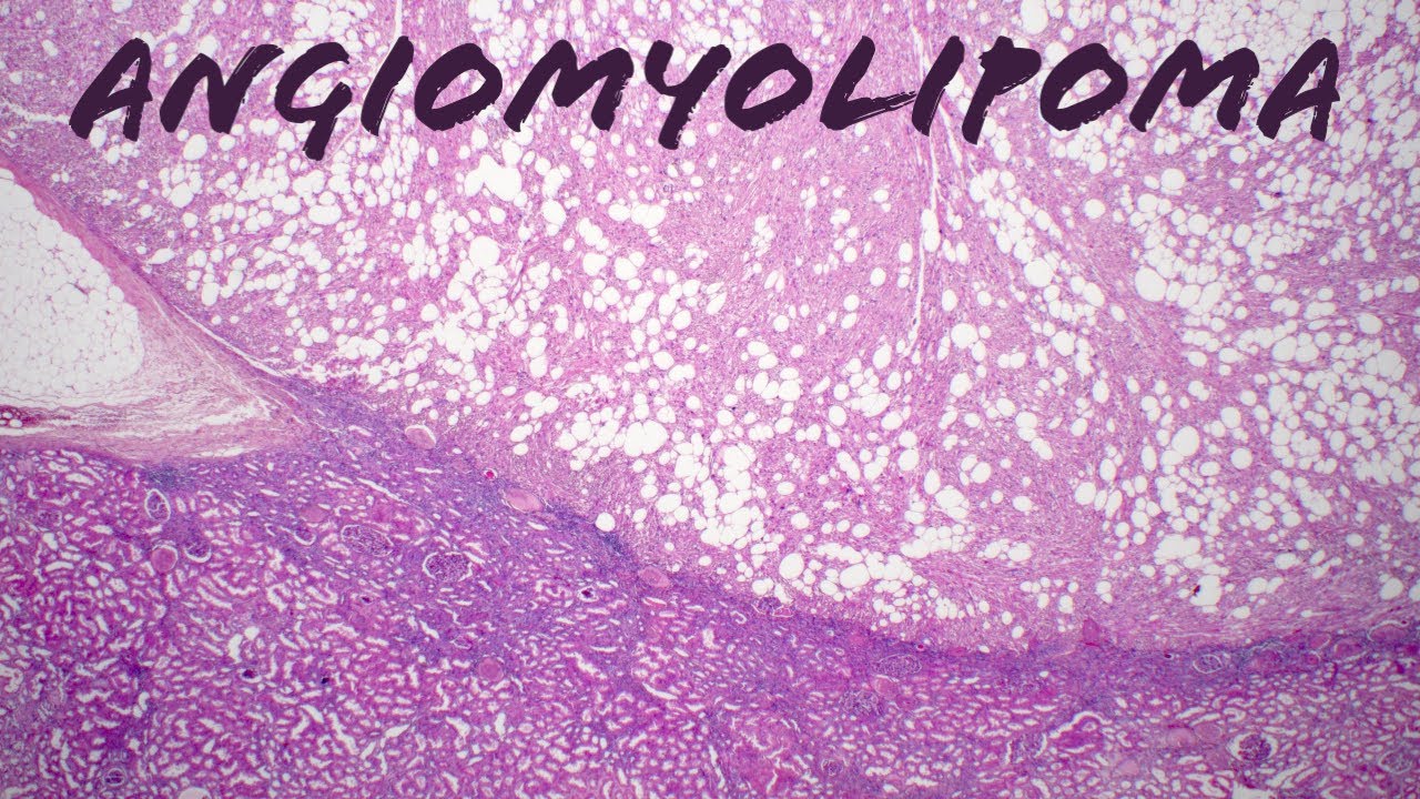 Angiomyolipoma of kidney (pathology histology PEComa tuberous sclerosis tumor usmle)