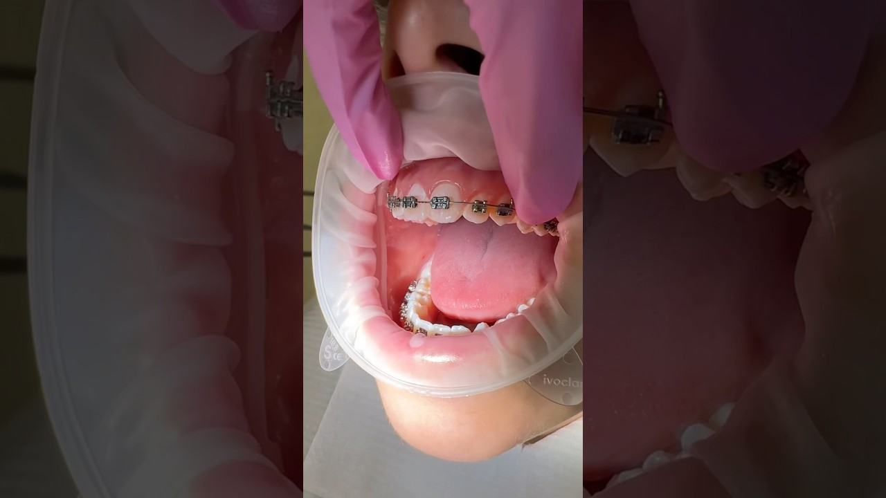 Kids braces for only £2500! Top and bottom! Send us an email tco@lumedental.co.uk