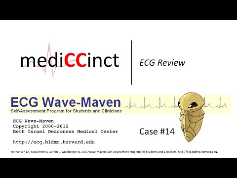Apical Hypertrophic Cardiomyopathy/Yamaguchi's Syndrome (ECG Wave-Maven) Case #14