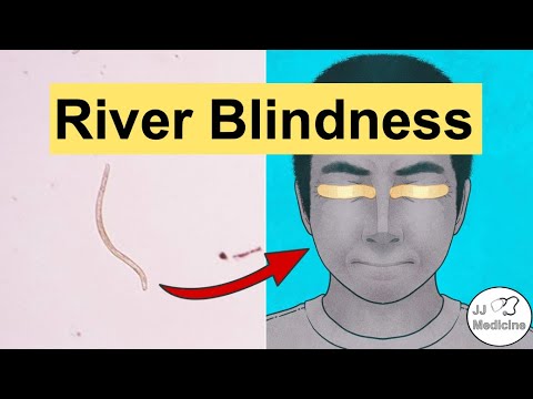 River Blindness (Onchocerciasis) | Causes, Pathophysiology, Signs & Symptoms, Diagnosis, Treatment