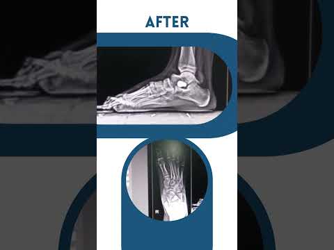 Flat foot pain? We’ve got a minimally invasive solution. #amblefootandanklecentre #flatfoot