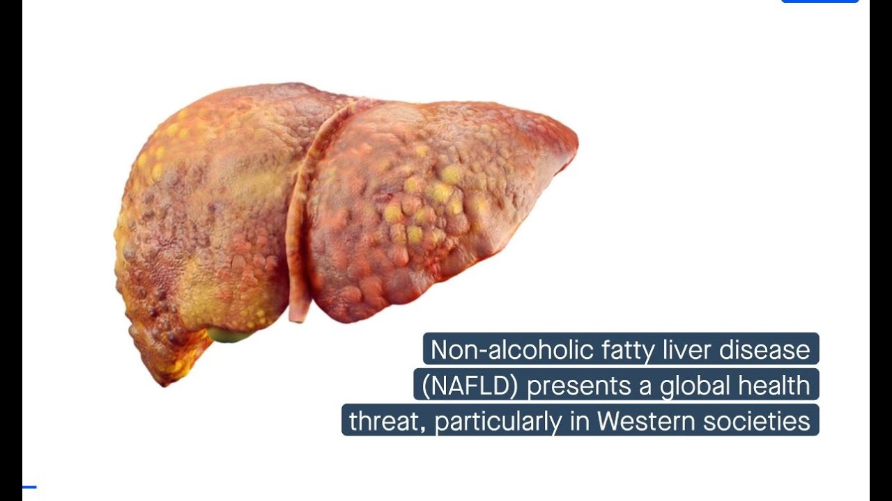 The promise of extracellular vesicles in tackling non-alcoholic fatty liver disease