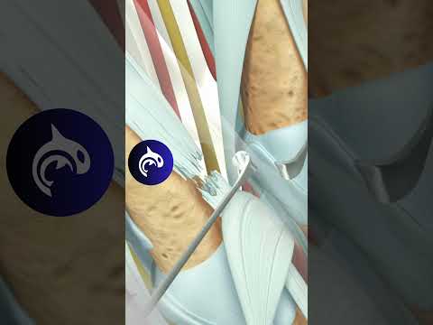 See how an Extensor Tendon Injury of the Hand is Repaired - 3D Animation