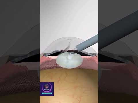 Cataract Surgery - 3D Animation