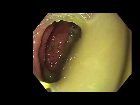 EUS-directed transgastric ERCP
