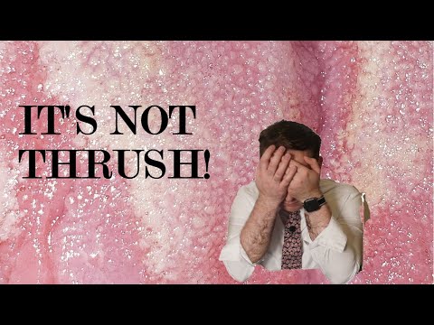 My BIGGEST Oral Pathology PET PEEVE: It's NOT Thrush