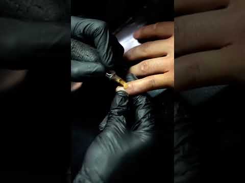 Vitiligo skin color tattoo coverup | Vitiligo skin disease treatment