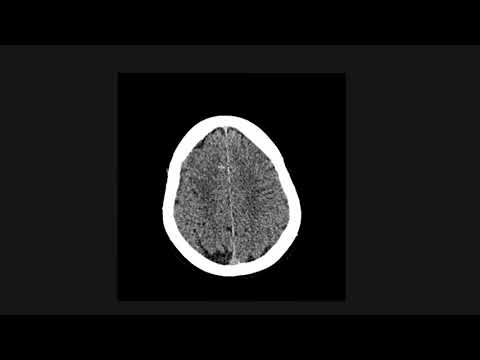 How to figure out non-traumatic causes of intracranial bleeding