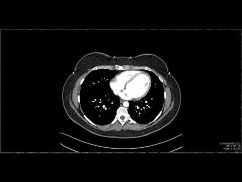 Abdominal Anatomy on Computed Tomography