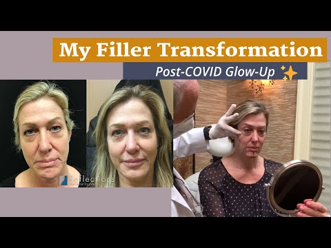 Lisa's Filler Facelift & Results #NonSurgicalFacelift #LiquidFacelift
