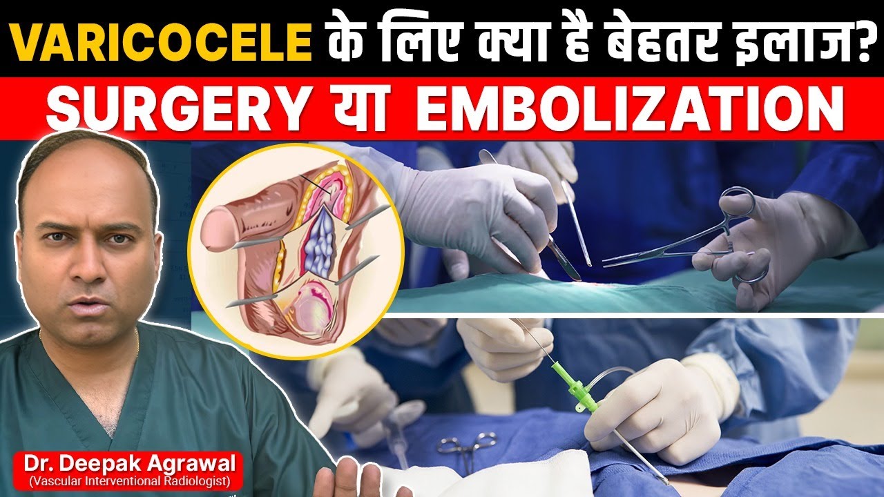Surgery VS Embolization for Varicocele in Hindi | What is the BEST TREATMENT of Varicocele?
