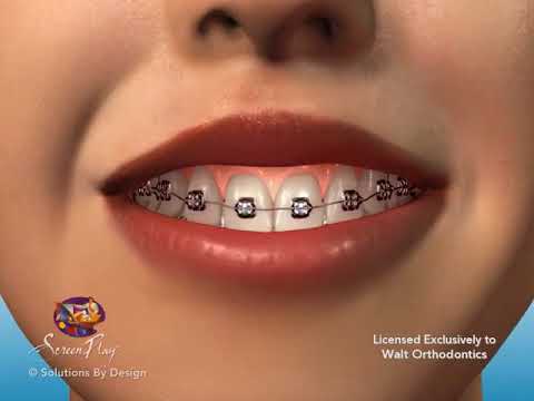 TAD Incisor Intrusion Plate.wmv Video Lecture - Dental