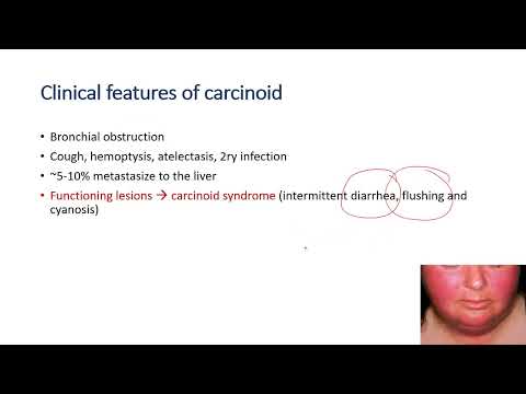 Lung neoplasia (COMLEX/USMLE review)