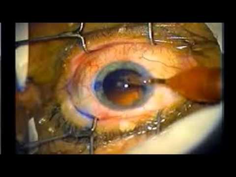 Cataract Eye Surgery