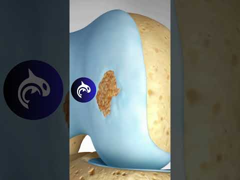 See how Damaged Knee Cartilage is restored in 3D Animation. Osteochondral Autograft (OAT)