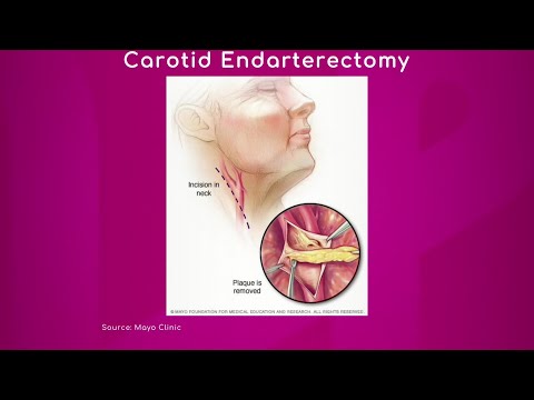 Carotid Artery disease: Endarterectomy