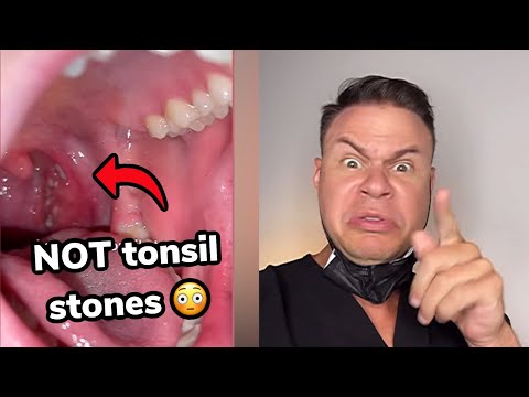 These May Look Like Tonsil Stones But They Are WAY Worse!