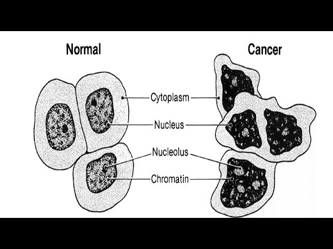 American Sign Language ASL Video Dictionary - cancer