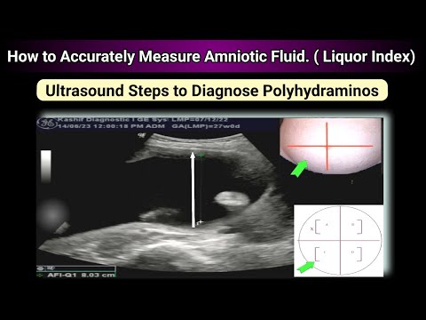 Ultrasound Pregnancy - How to Measure Amniotic Fluid Accurately ( Fluid around Baby ) Polyhydraminos