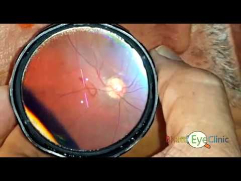 posterior vitreous detachment